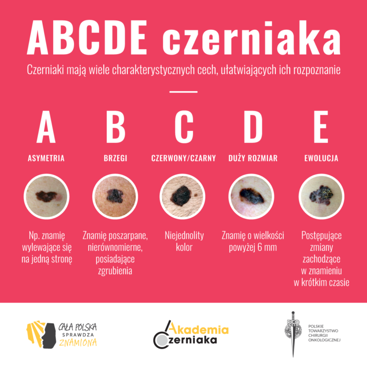 Czerniak – nowotwór, który można wyleczyć. Rola fizjoterapeuty we ...